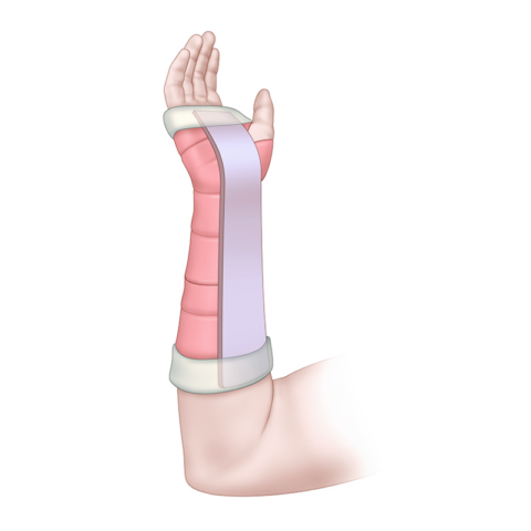 Splinting | Fractures.app